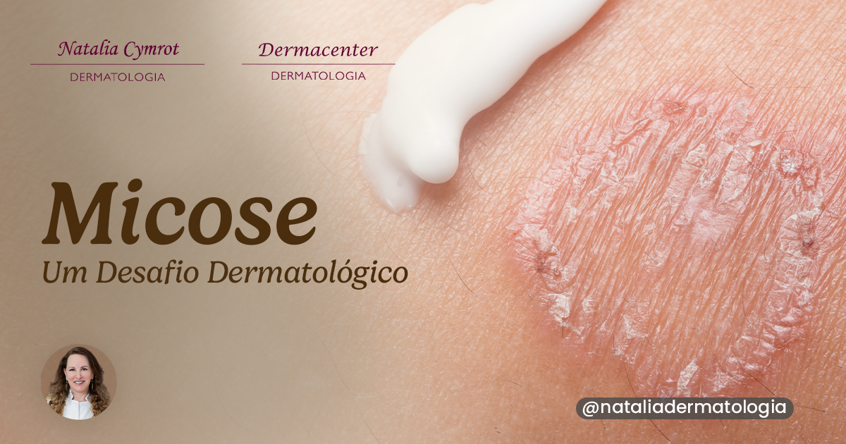 Micose: um desafio dermatológico - Clínica Natalia Cymrot & Clínica ...