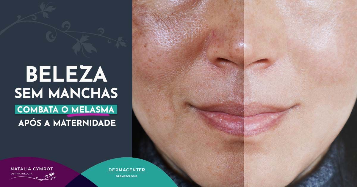 Beleza sem manchas: combata o Melasma após a maternidade - Clínica ...