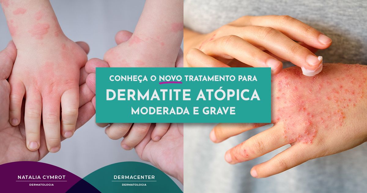 Conheça o novo tratamento para dermatite atópica moderada e grave ...