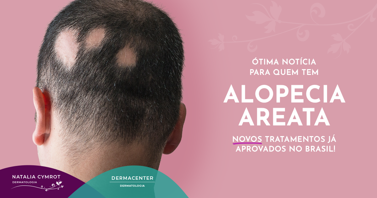 Ótima notícia para quem tem Alopecia Areata! Novos tratamentos já ...