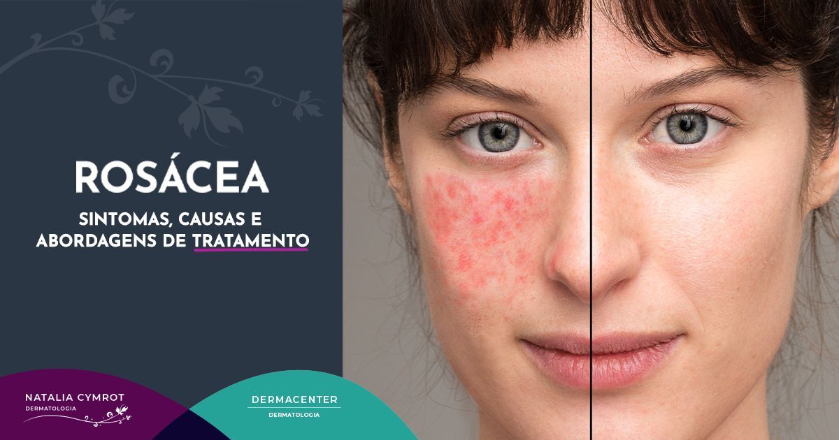 Rosácea: sintomas, causas e abordagens de tratamento - Clínica Natalia ...