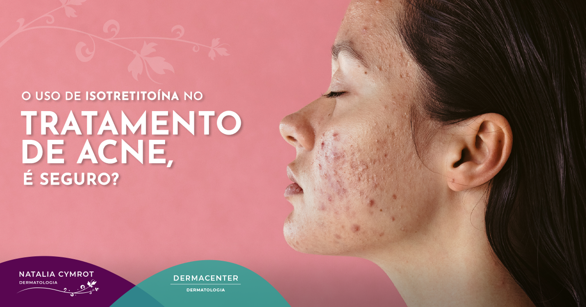 O uso de isotretinoína no tratamento de acne, é seguro? - Clínica ...