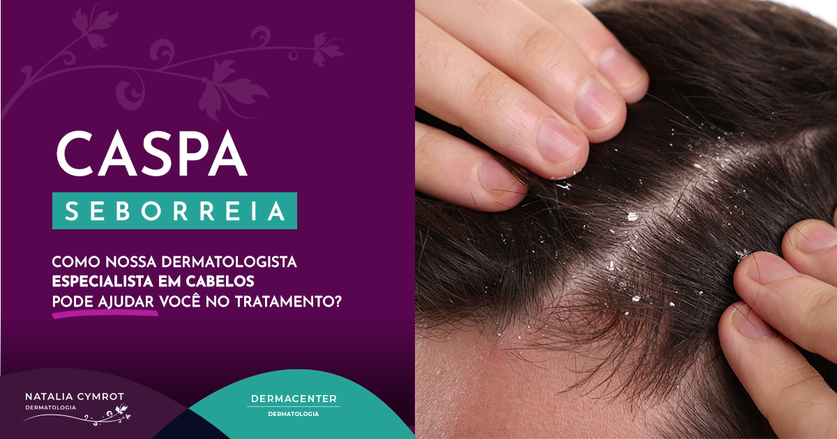 Caspa (seborreia): como nossa dermatologista especialista em cabelos ...