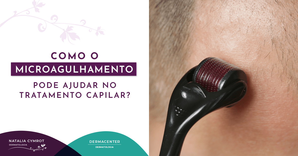 Como o microagulhamento pode ajudar no tratamento capilar? - Clínica ...