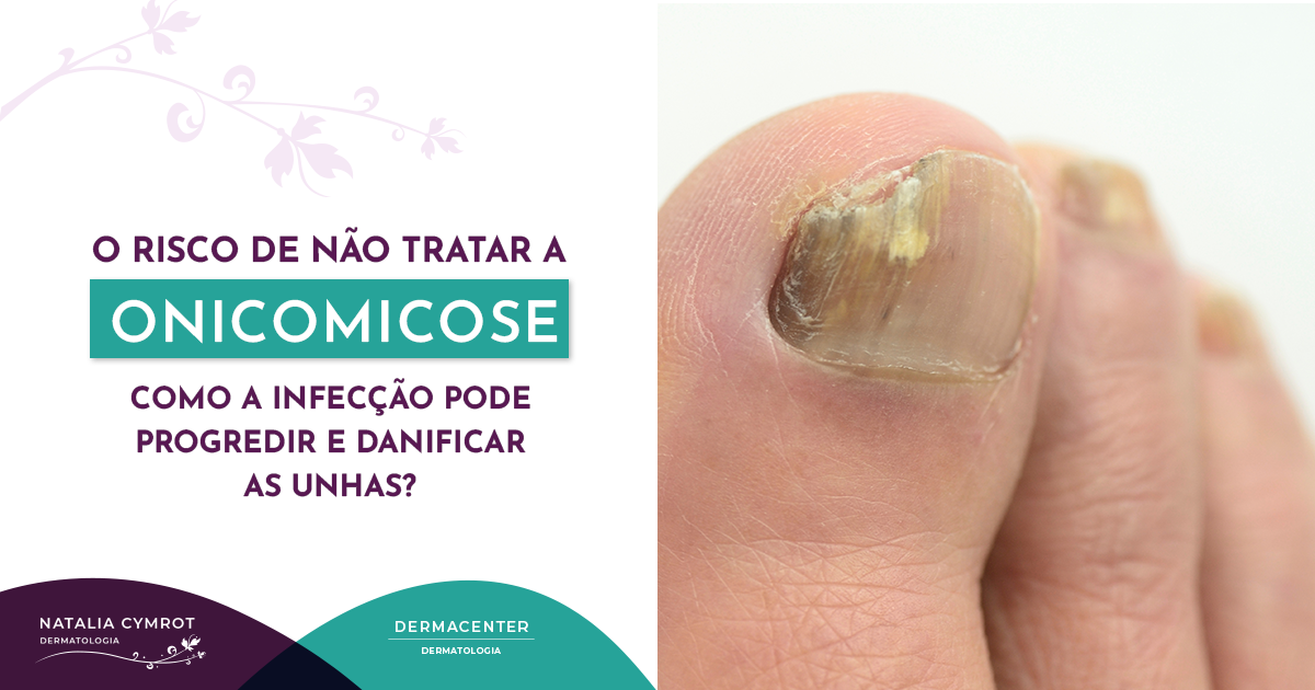 O risco de não tratar a onicomicose: como a infecção pode progredir e ...