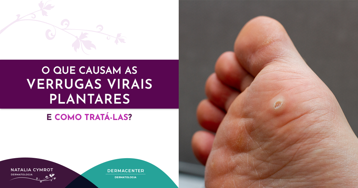 Verruga Plantar