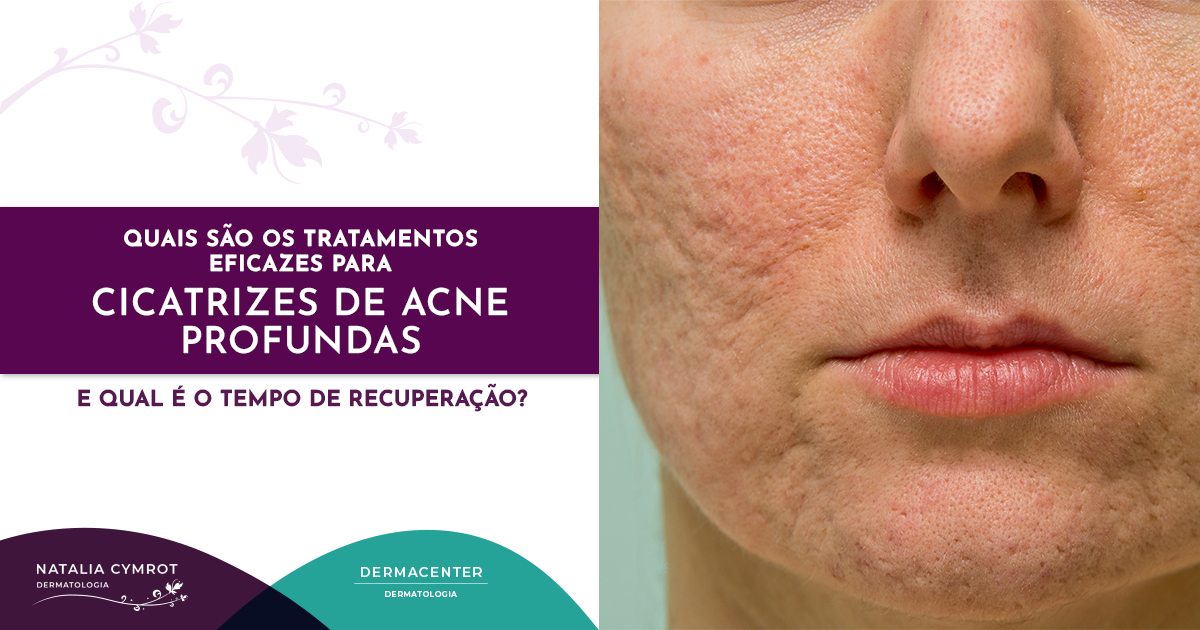 Quais são os tratamentos eficazes para cicatrizes de acne profundas e ...