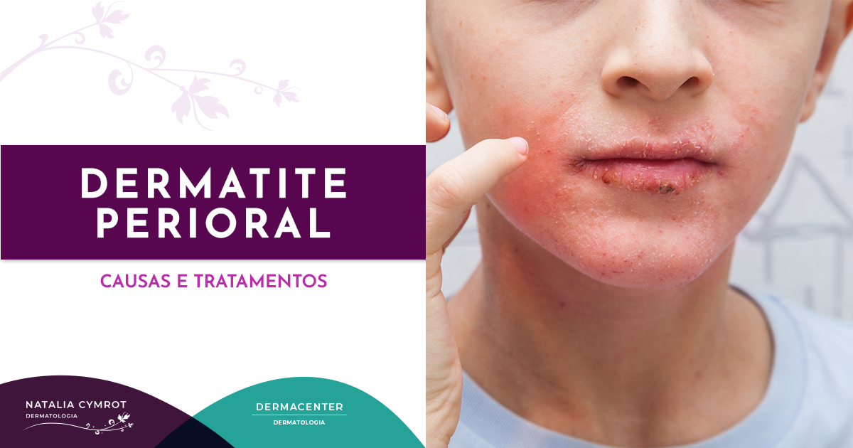Dermatite perioral: causas e tratamentos - Clínica Natalia Cymrot ...