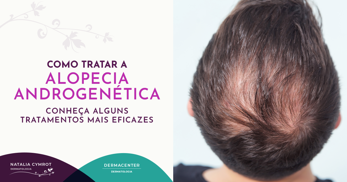 Como tratar a alopecia androgenética- conheça alguns tratamentos mais ...